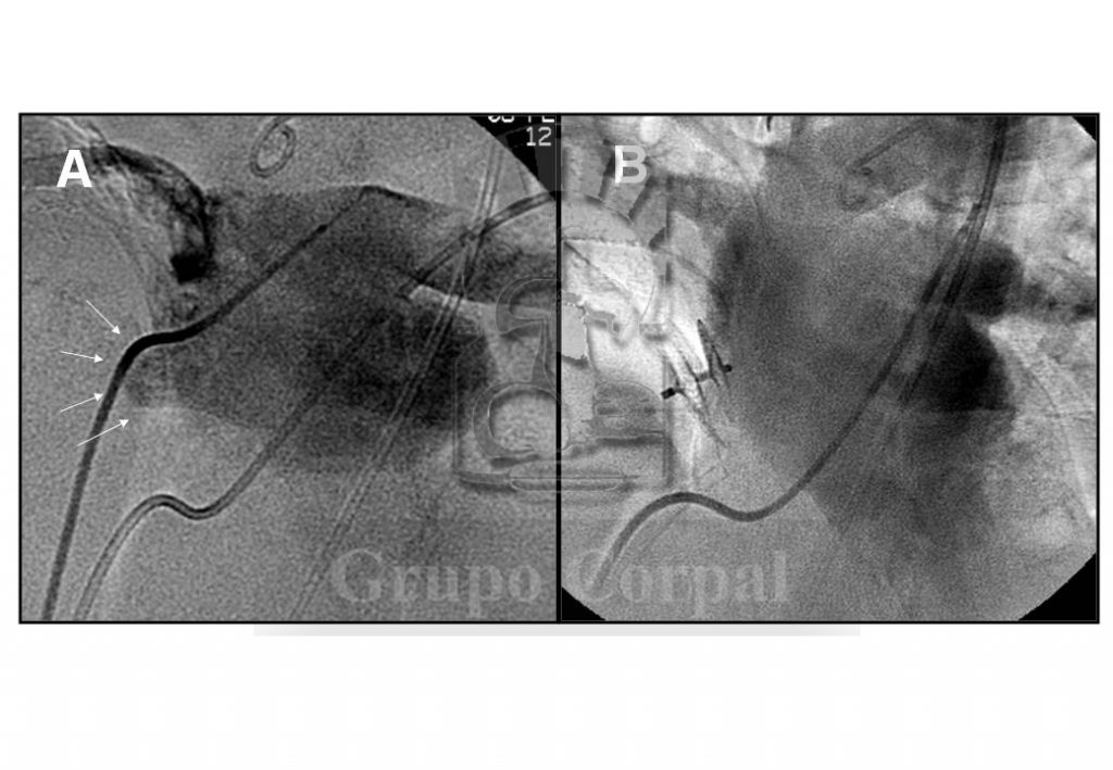 Cierre de Foramen Ovale Permeable, tratamiento percutáneo cardiopatía