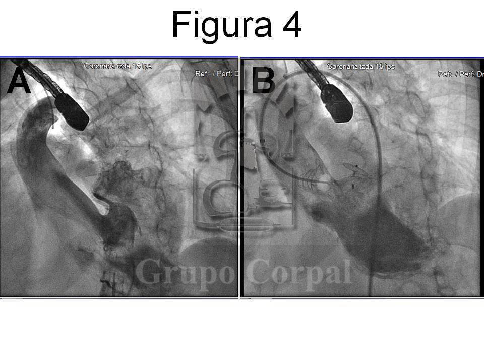 paciente con Platipnea Ortodesoxia y Vena Acigos asociada, cierre FO