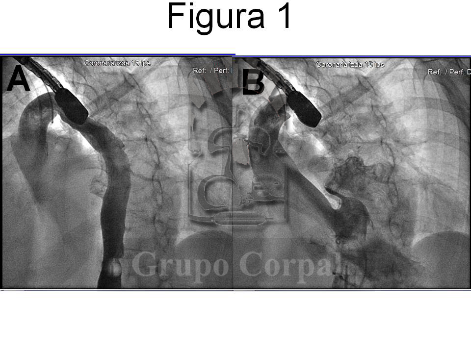 paciente con Platipnea Ortodesoxia y Vena Acigos asociada, cierre FO