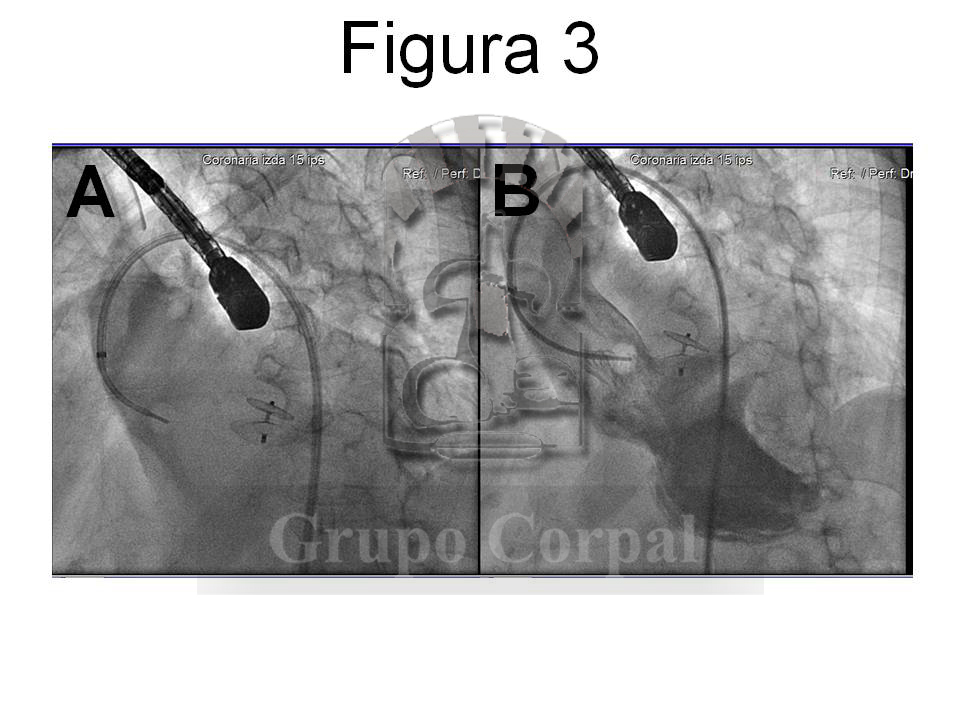 paciente con Platipnea Ortodesoxia y Vena Acigos asociada, cierre FO