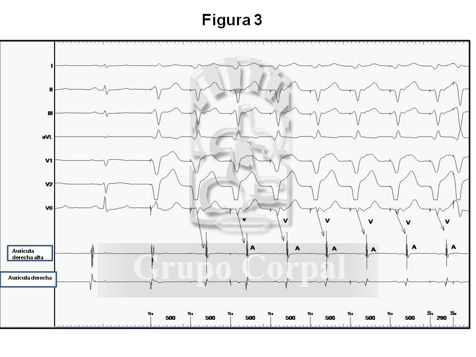Taquicardia paroxística supraventricular (TPSV), estudio electrofisiológico