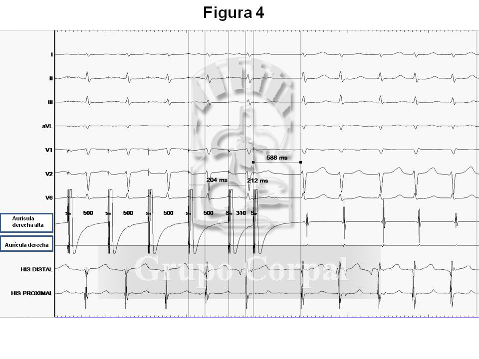 Taquicardia paroxística supraventricular (TPSV), estudio electrofisiológico