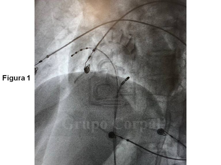 Taquicardia paroxística supraventricular (TPSV), estudio electrofisiológico