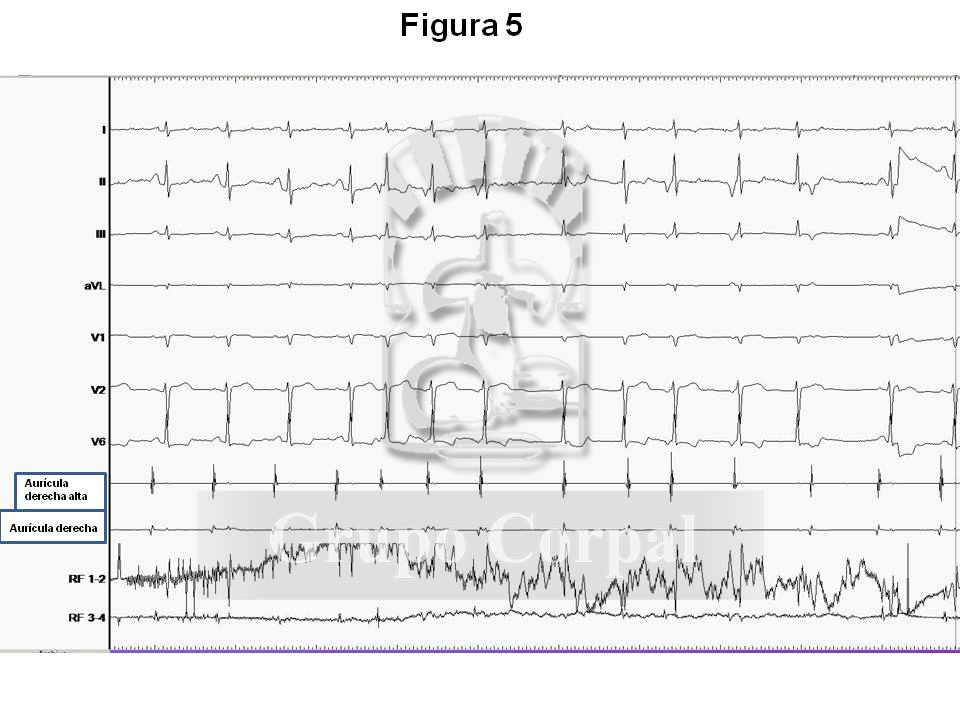 Taquicardia paroxística supraventricular (TPSV), estudio electrofisiológico