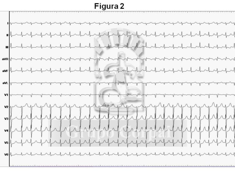 Taquicardia paroxística supraventricular (TPSV), estudio electrofisiológico