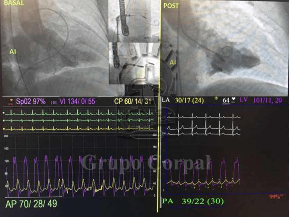 Implante de 2 Mitraclips. Prolapso de valva posterior. - Grupo Corpal