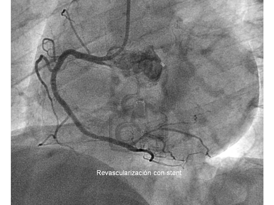 Paciente con angina inestable . Presión precordial con el esfuerzo.