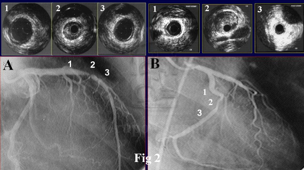 Estenosis coronarias severas - Grupo Corpal