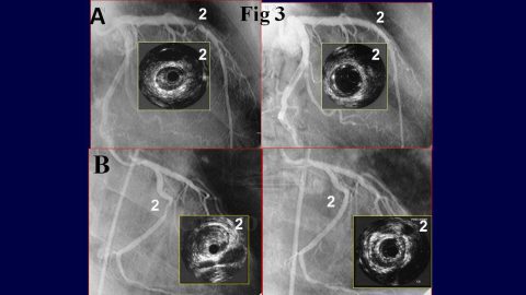 Estenosis coronarias severas - Grupo Corpal