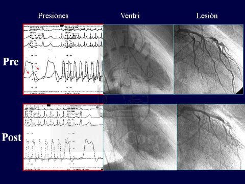 Insuficiencia mitral transitoria secundaria a isquemia miocárdica